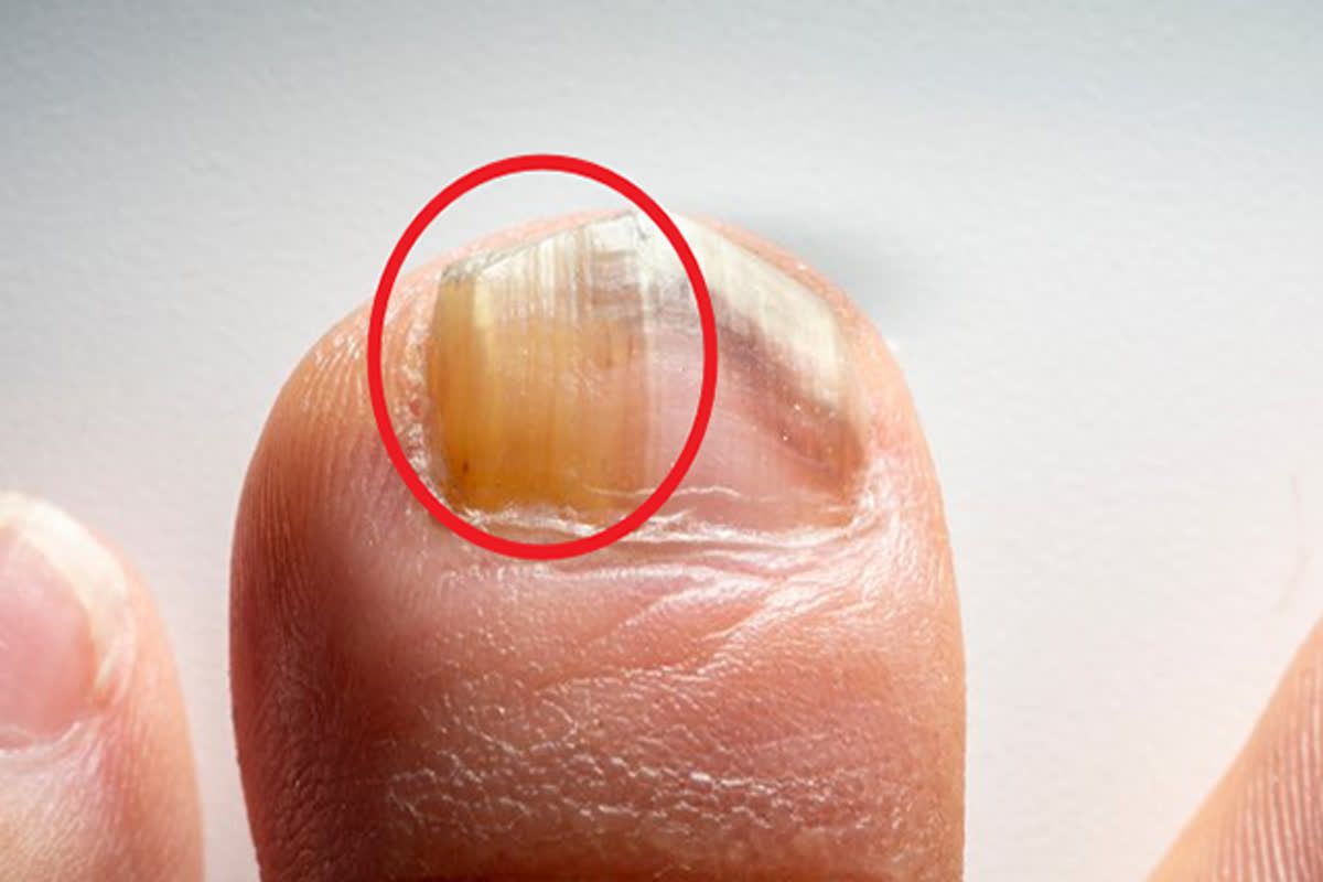 Are Your Toenails Turning Yellow? Watch Out for These Health Warnings